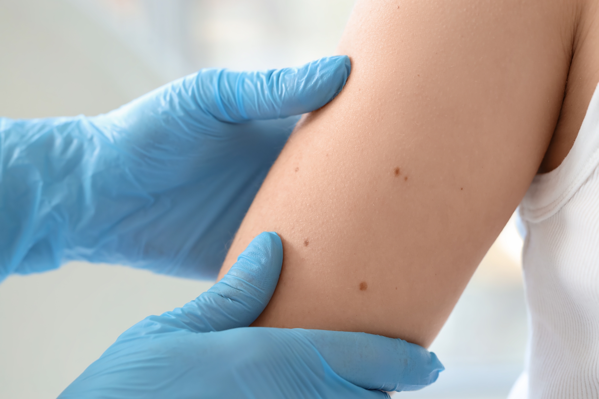 Cancer de la peau : "Je suis dermatologue et voici les 2 signes ...