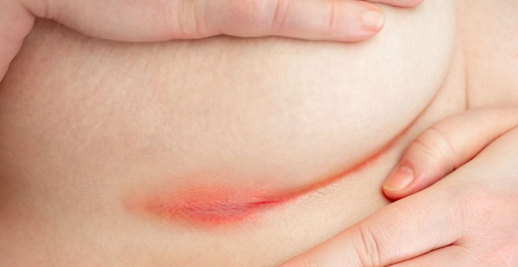 Transpiration sous les seins : le seul produit efficace