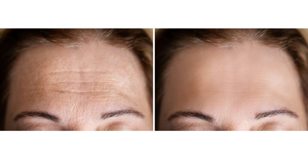 Effet botox visible sur les rides, le soin notox sans injection